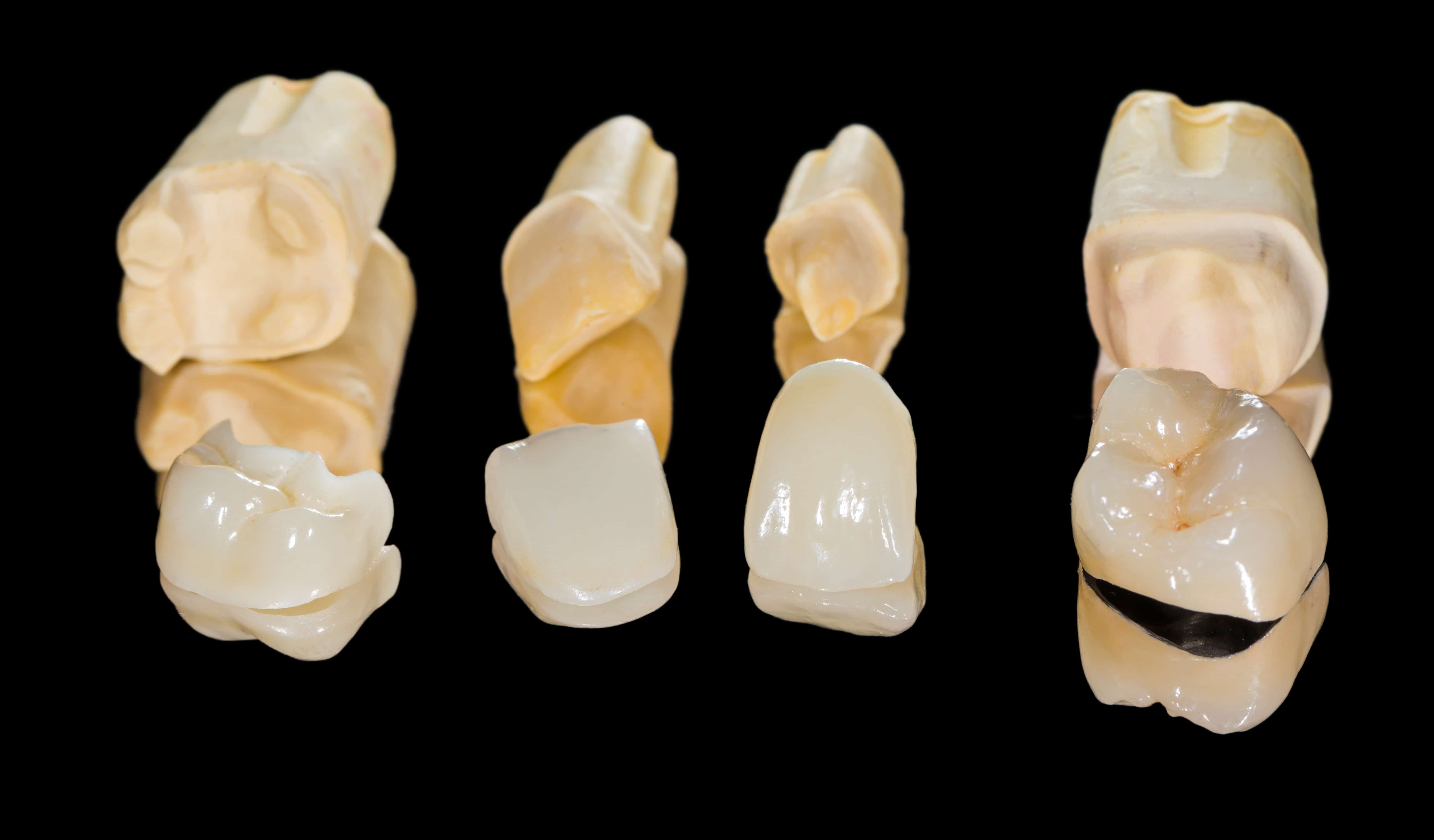 Does My Smile Need A Custom-Made Crown? | Richfield, MN