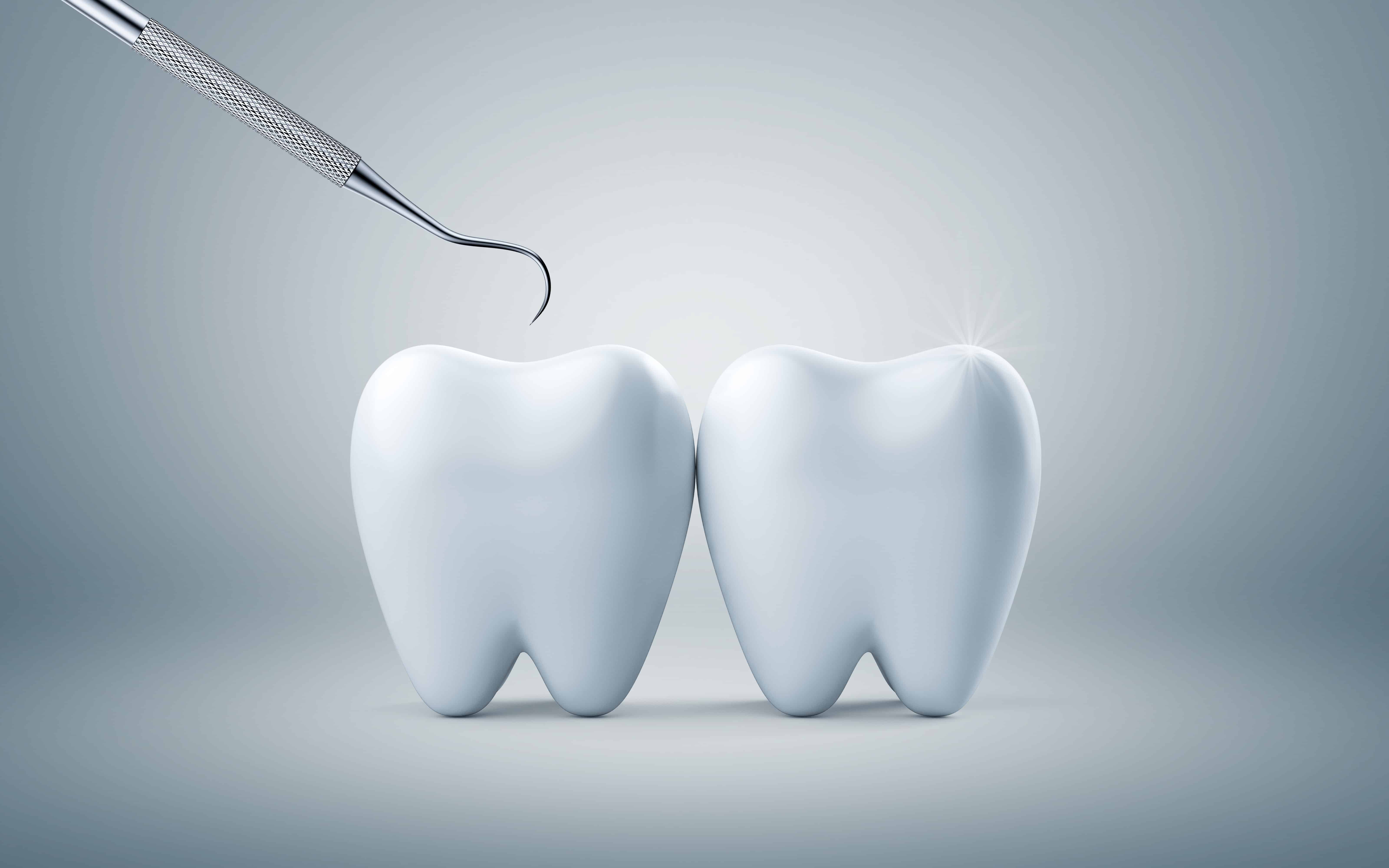 Richfield Dentist Removes Plaque Buildup With A Cleaning | Richfield, MN