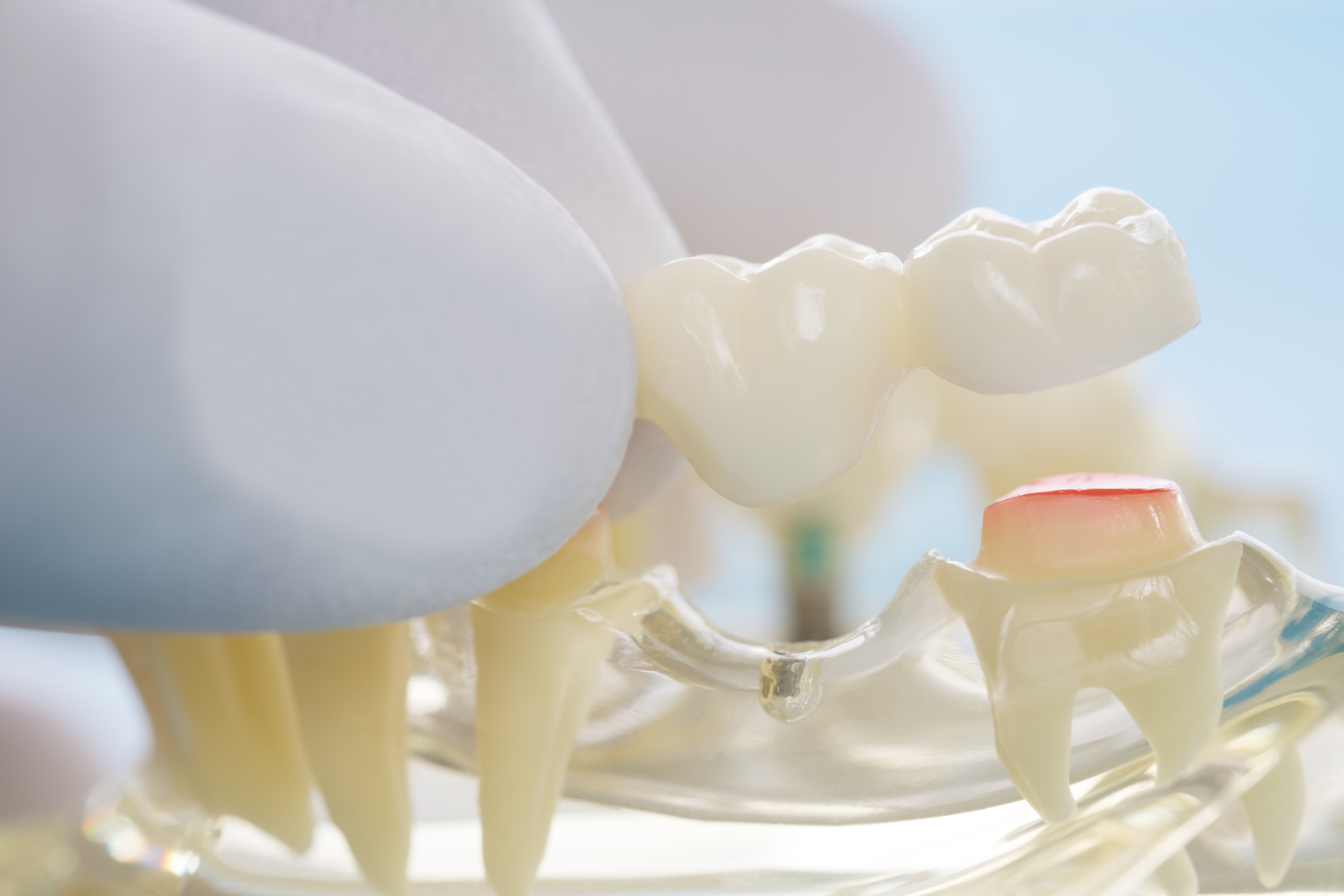 Creating A Lifelike Dental Bridge | Richfield, MN