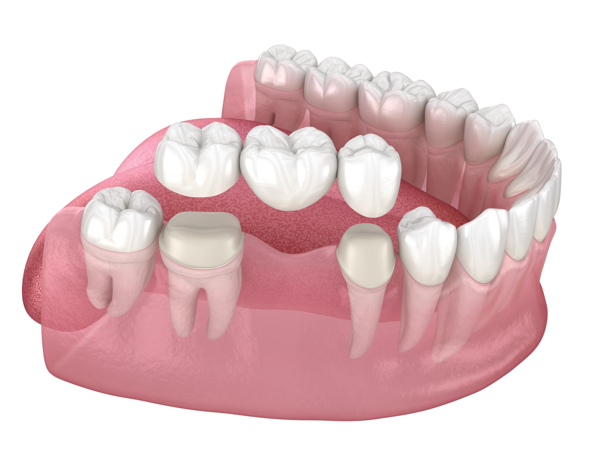 A Dental Bridge Replaces Missing Teeth | Richfield, MN