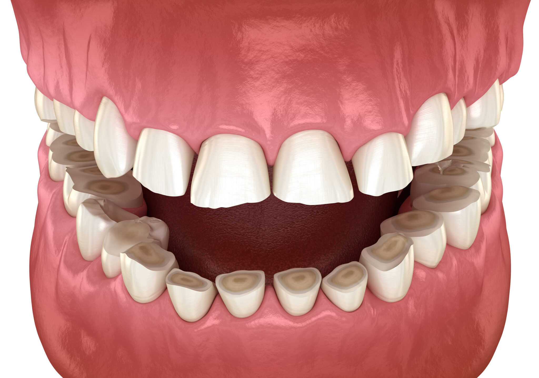 Bruxism Could Damage Your Teeth | Richfield, MN